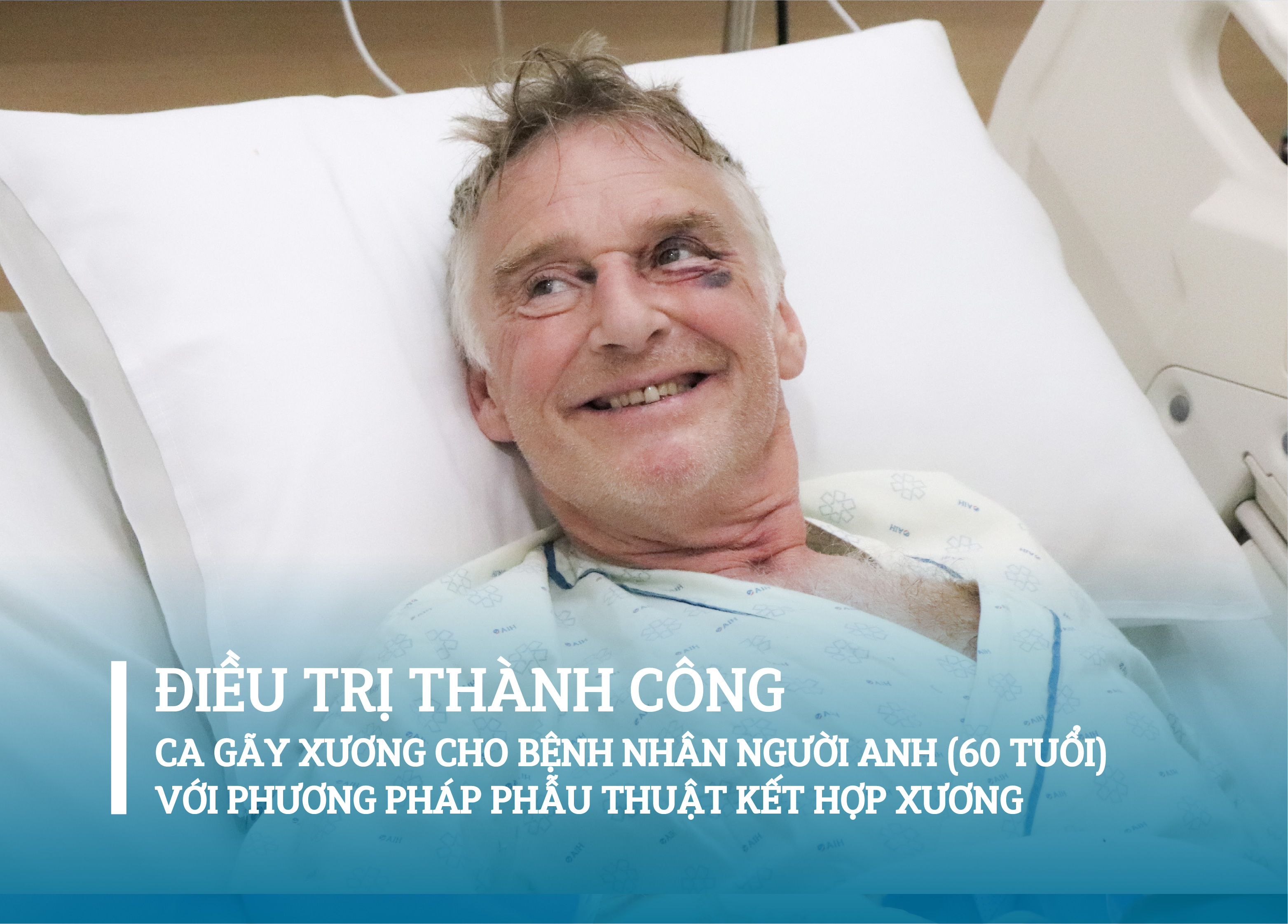 ĐiỀu TrỊ ThÀnh CÔng Ca GÃy XƯƠng Cho BỆnh NhÂn NgƯỜi Anh 60 TuỔi VỚi